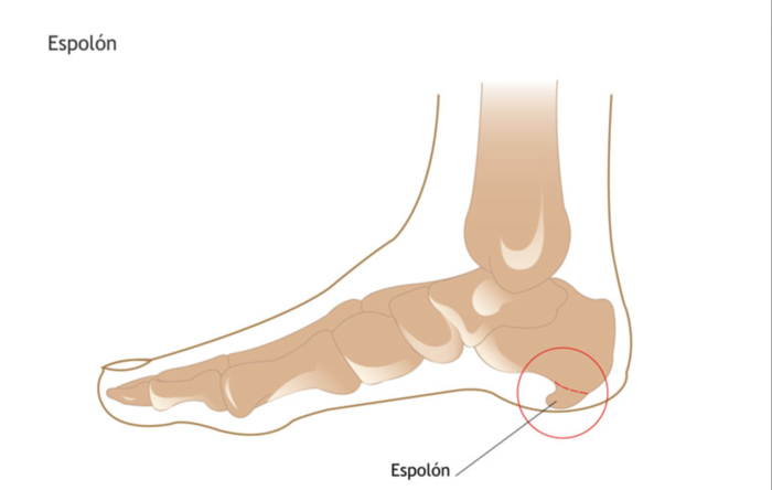 Dolor en talón diagnosticado como espolón ...