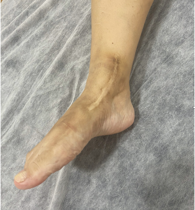 Dolor periarticular en pie y distrofia simpática refleja ...